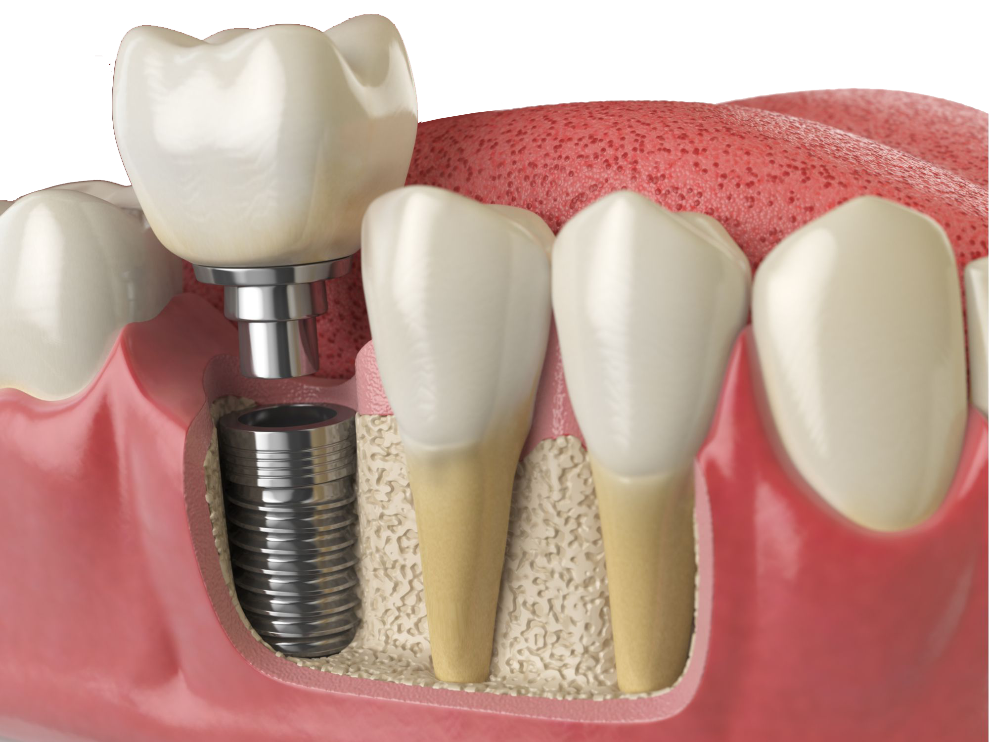 DENTAL IMPLANTS – Perio Surgery